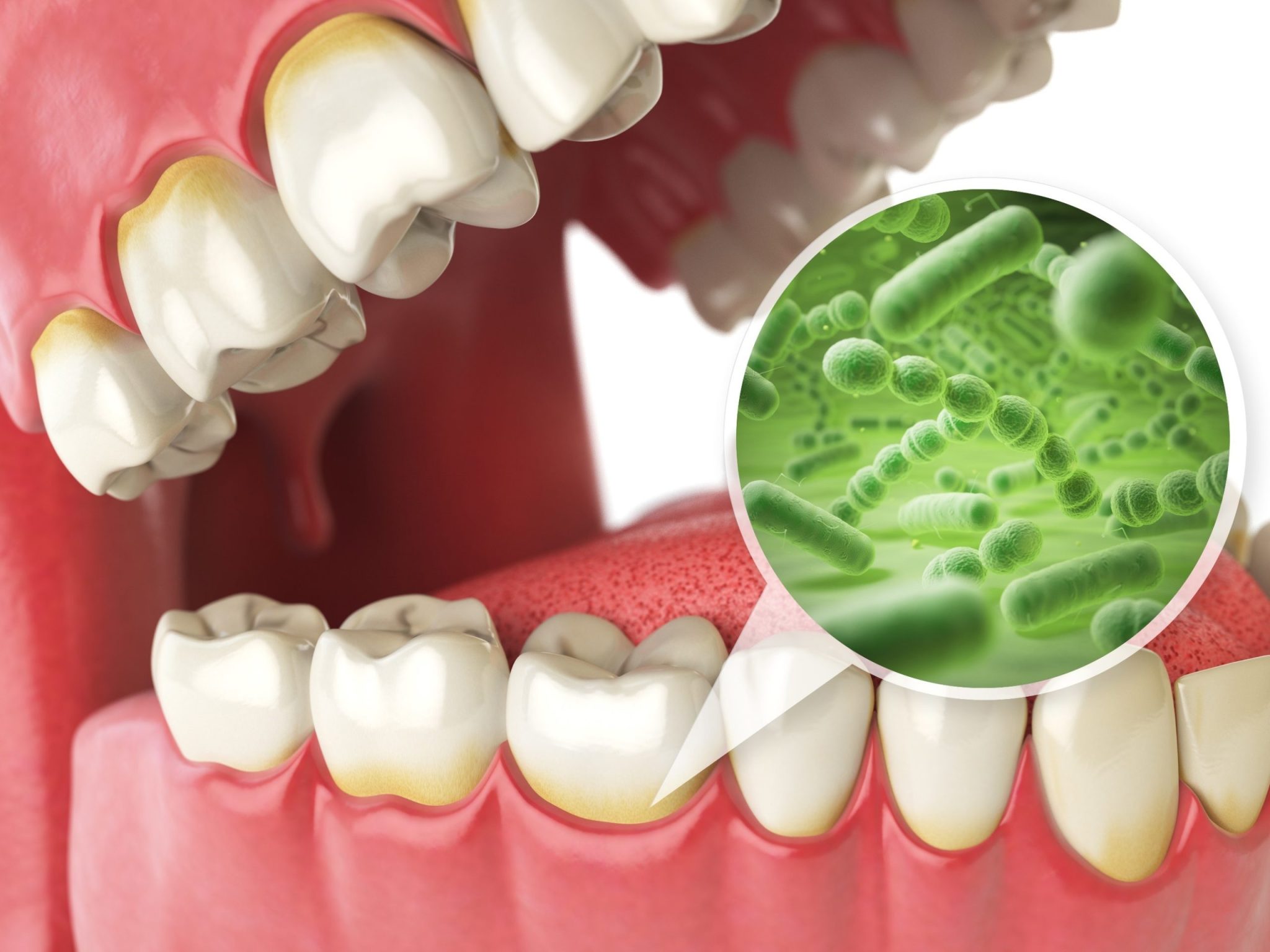 How Poor Oral Hygiene Leads to Periodontal Issues